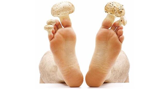 ¿Cómo y con qué tratar los hongos en los pies en casa? - Exodermin